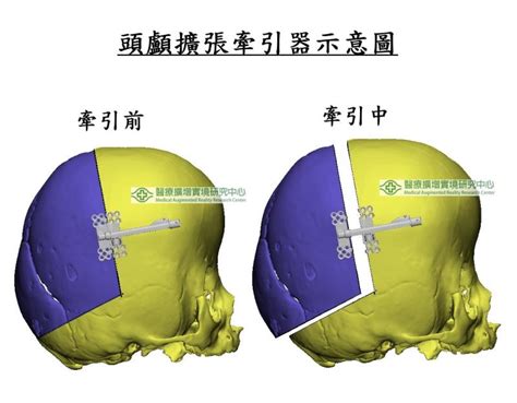 罕見疾病 多條顱縫早閉症 醫籲：及早擴張腦容量 把握大腦黃金成長期婦幼 Kingnet國家網路醫藥