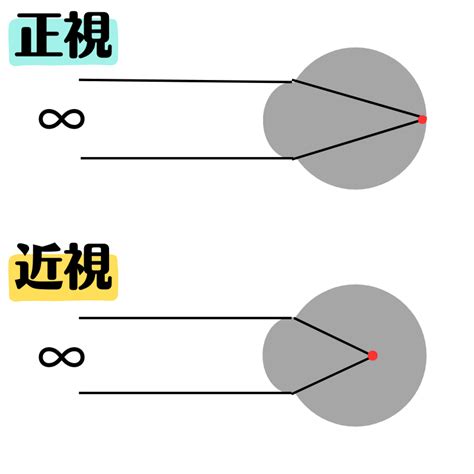 視力検査に役立つ眼科看護師が知っておきたい近視遠視乱視の豆知識 Contactキャリア
