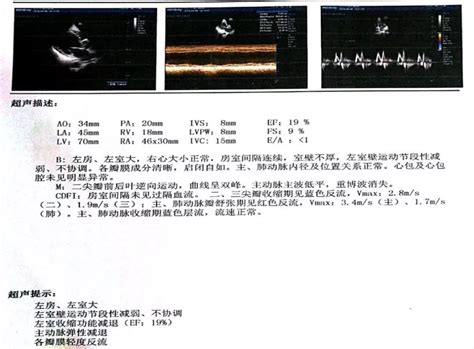 从典型病例看扩张型心肌病的超声心动图诊断与鉴别诊断 左室 动态图库网