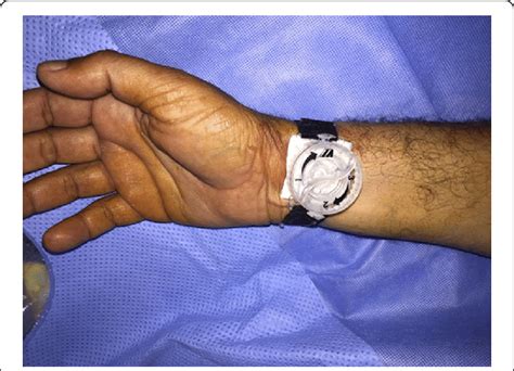 Finale Radial Compression Device Download Scientific Diagram