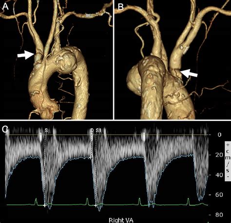 Anteroposterior A And Posteroanterior B CTA Showing Severe Stenotic