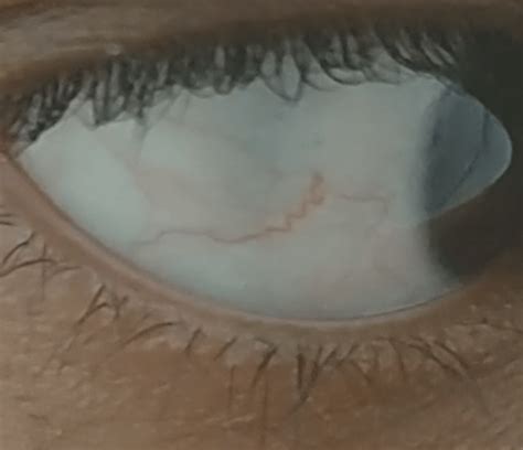How My Right Eye Looks Rdryeyes