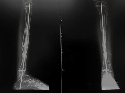 Osteogenesis Imperfecta Gejala Penyebab Dan Pengobatan Alodokter