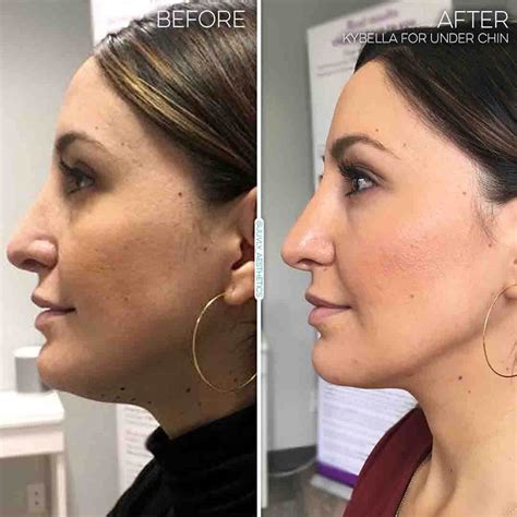 What Is Kybella Juvly Aesthetics