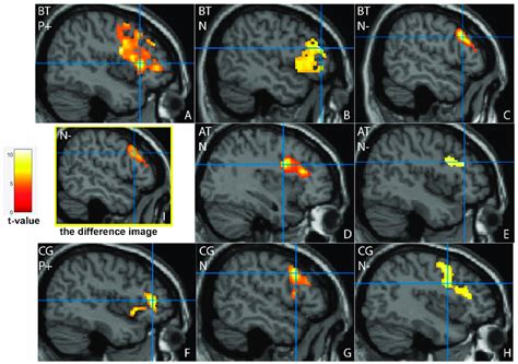 Activation Of The Frontal Cortex In Patients Before BT A C After Download Scientific