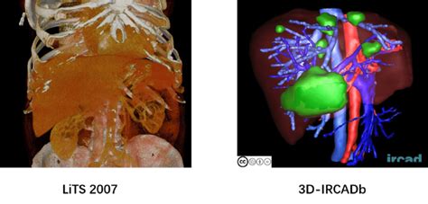 The Scans In Liver Tumor Segmentation Challenge Lits 2017 Dataset And