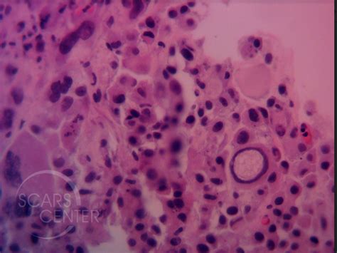 Recurrent Melanoma Skin Cancer And Reconstructive Surgery Center
