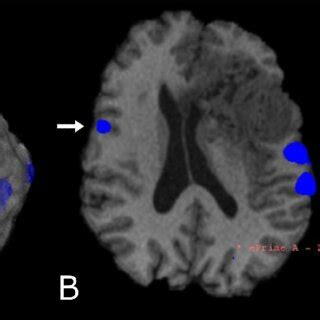 Language Task Based FMRI FMRI Correlation Maps Of Cortical Activation