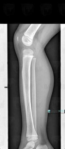 Radiology Case Fracture X Rays Diagnologic