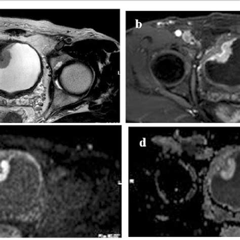 Vi Rads Scoring Rule Schematic Ce Contrast Enhanced Dw Diffusion