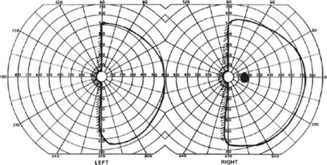 Visual Dysfunction From Lesions Of The Cerebral Cortex Ento Key