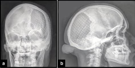 Skull Radiographs Showing The Intact Titanium Mesh With Good Contour Of