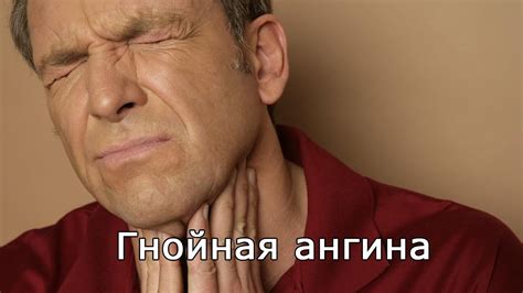 Гнойная ангина Youtube