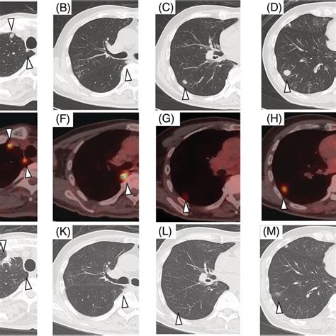 Computed Tomography Ct Findings Showed Multiple Pulmonary Nodules In