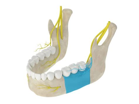 Render Mandibular Arch Gow Gates Nerve Block Types Dental Anesthesia