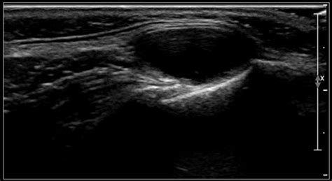 Dermoid Cyst Neck Mri