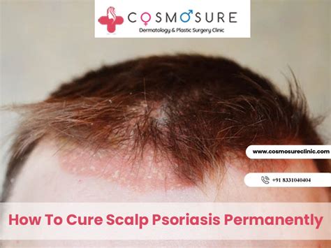 How To Remove Psoriasis Scales From Scalp Naturally At Santiago