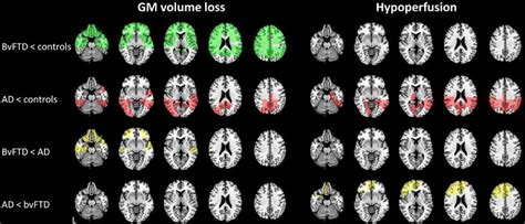 Overview Of Grey Matter Gm Regions Showing Group Differences Between