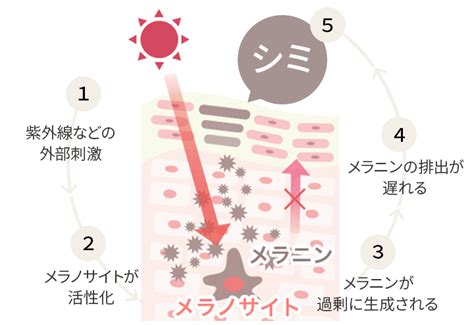 シミの種類 美容皮膚科 銀座フェミークリニック