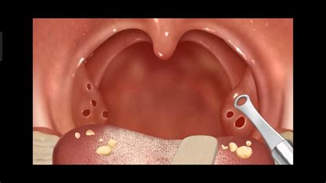 Asmr Tonsils Stones Removal Asmr Removal Tonsils Surgery Animation