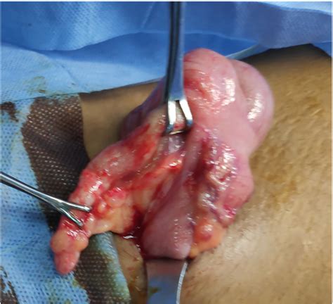 Catarrhal Inflammation Of The Vermiform Appendix Download Scientific