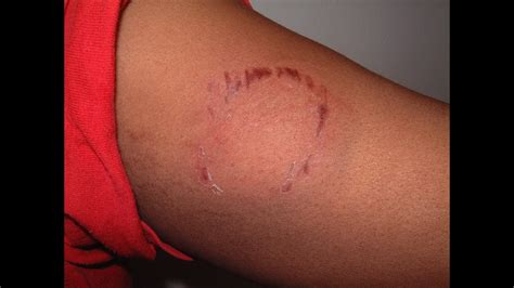 Types Of Human Bite Marks At Nicole Routh Blog