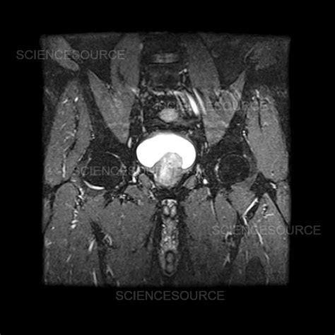 Enlarged Prostate Gland Stock Image Science Source Images