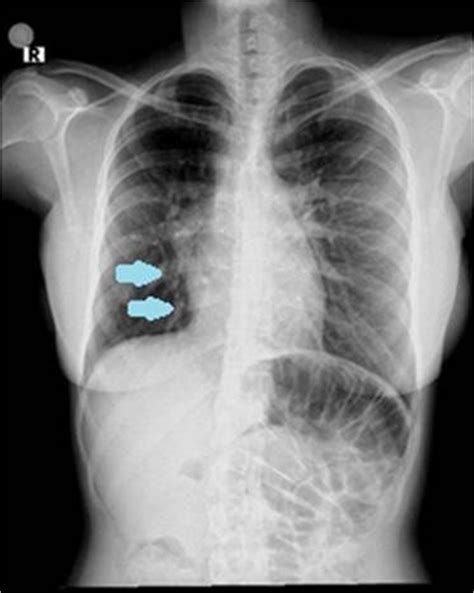X Ray Of Lungs With Asthma