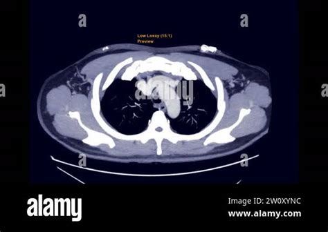 Cta For Pe Or Pulmonary Embolism Ct Chest With Contrast Media Agent Axial Mip View For Detect