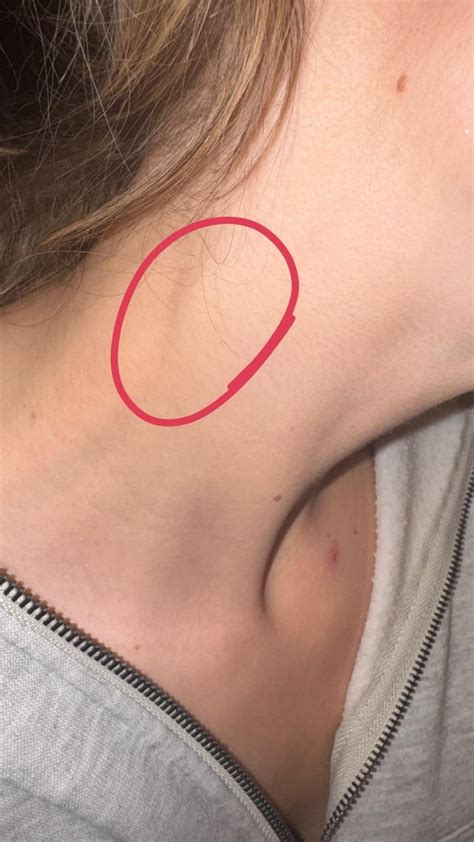 Is This A Vein Popping Out Near My Sternocleidomastoid In My Neck Or