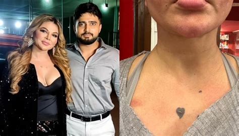 Rakhi Sawant Shows Bruises She Allegedly Got From Adil Her Brother