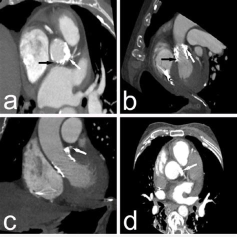 A Angiography Showing Ostial Lmca Occlusion B Patient Rca