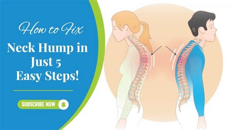 How To Fix Neck Hump In Just 5 Easy Steps YouTube