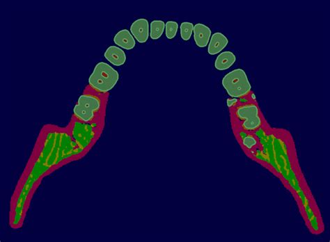 The Segmentation Of The Cbct Iv Discussion Many Studies Have Been