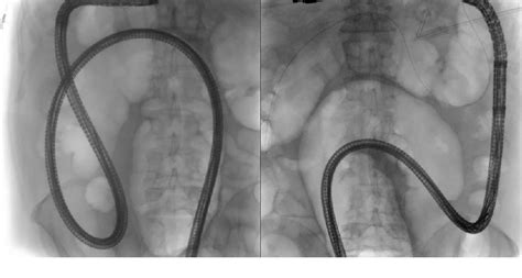 Figure 2 From Recurrent Sigmoid Volvulus Secondary To A Large