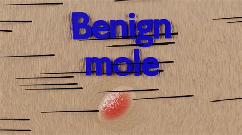 Mole Nevus Cancer Malignant Melanoma Differences 3d Blender Market