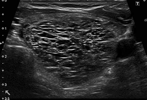 European Thyroid Association Guidelines For Ultrasound Malignancy Risk