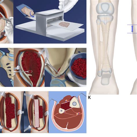 Paley Classification Of Congenital Pseudarthrosis Of The Tibia Type 1 Download Scientific