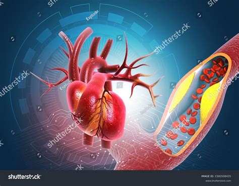 Human Heart Clogged Arteries On Scientific Stock Illustration