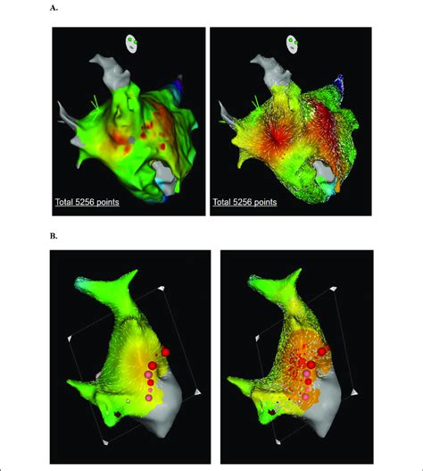 A Activation Map Of The Left Atrium During High Right Atrial Pacing