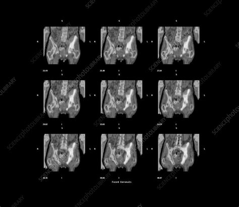 Bone Cancer Ct Scans Stock Image C014 8084 Science Photo Library