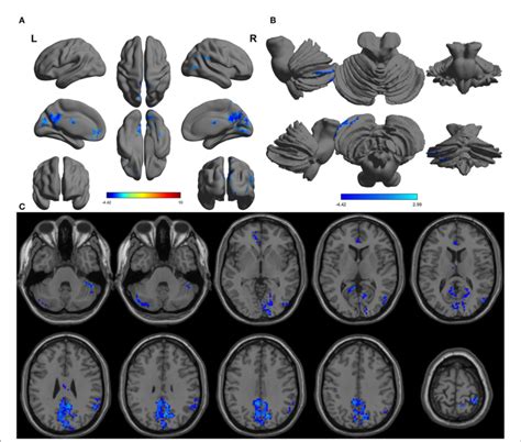 Figure Altered Peraf In Patients With Alcohol Dependence Relative To
