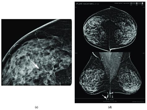 Ai Cad Detected Microcalcifications On Screening Mammography In A