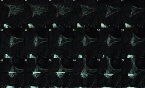 Sagittal View Of Cbct Images In Case No 2 A B Grafted Areas 6