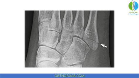 5th Metatarsal Fracture Orthofixar
