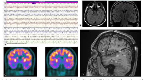 figure 1 from auditory aura from the hippocampus not all that ‘rings