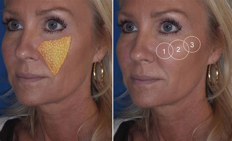 Facial Implants Clinical Tree