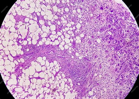 Premium Photo Photomicrograph Of Breast Abscess Granulomatous