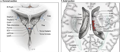 Ventricular And Periventricular Arteriovenous Malformations Neupsy Key