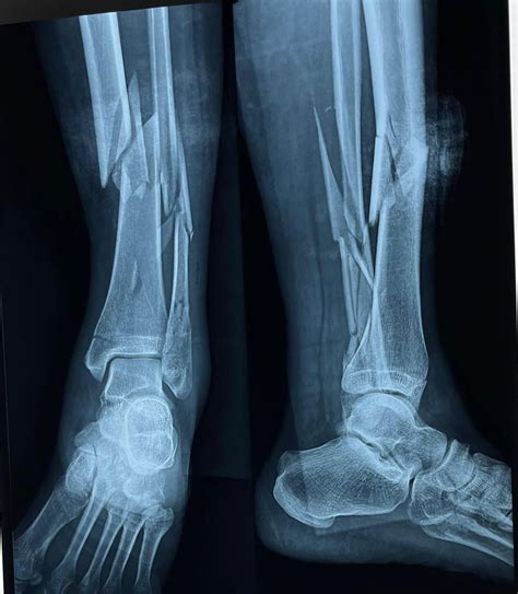 Spiral Fracture Tibia Recovery